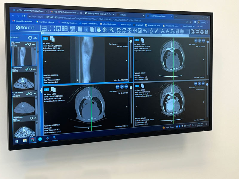 Percutaneous Transvenous Coil Embolization (PTCE) - MISCA Specialty ...